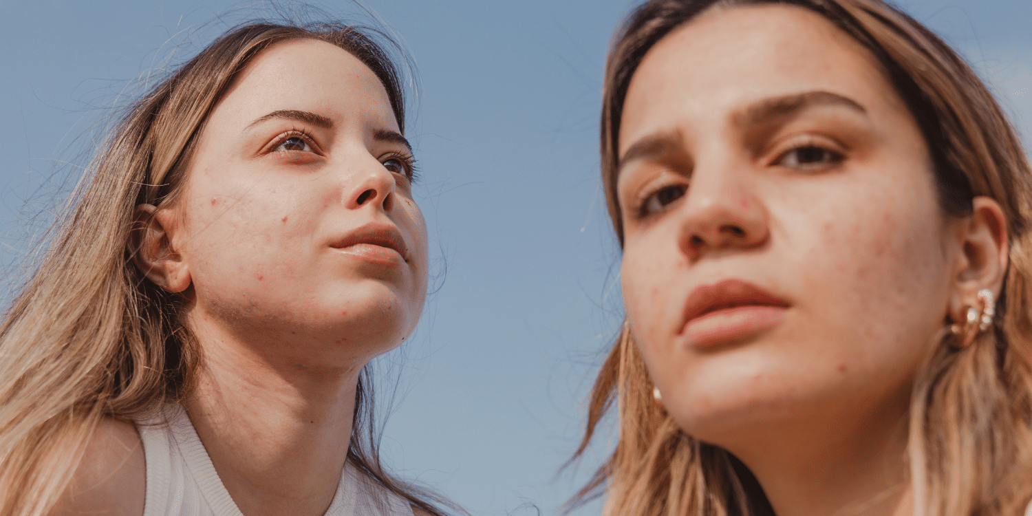 How to Get Rid of Scars from Acne | Top Acne Scarring Treatments