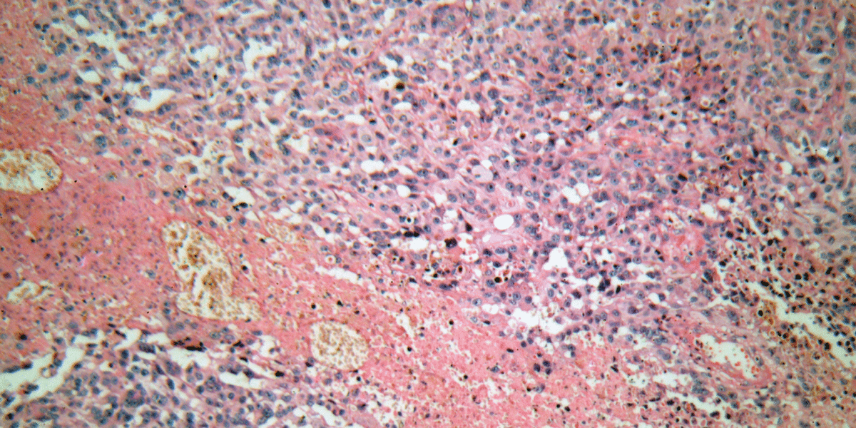 Causes & Prevention of Ochronosis | Ochronosis Treatment