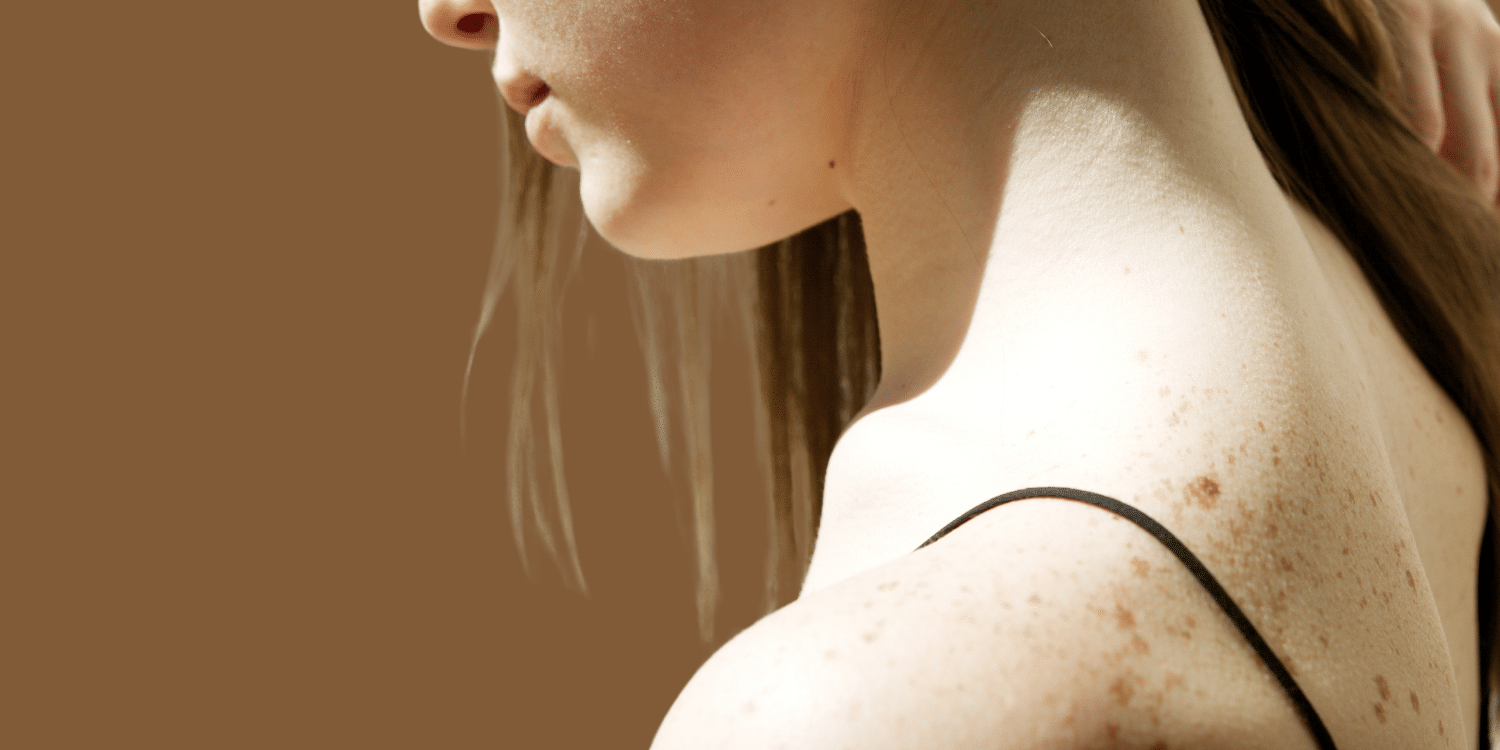 Sunspots on the Skin: Causes, Prevention & Treatments