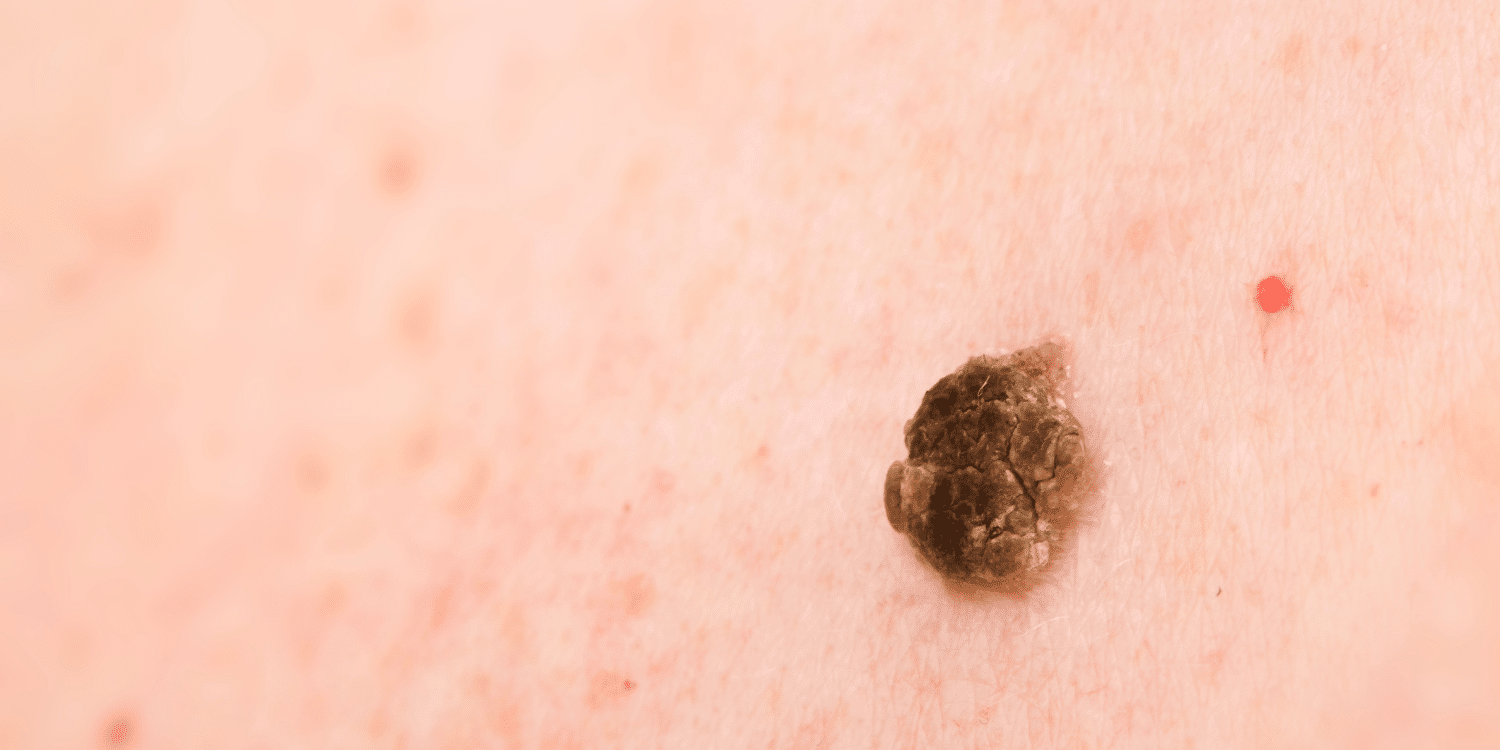 What Causes Seborrheic Keratosis & How to Get Rid of it