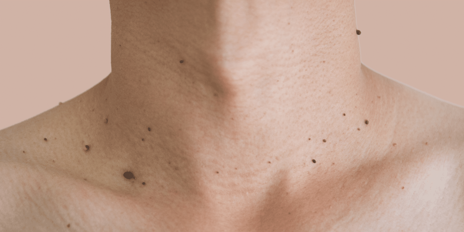 What Causes of Skin Tags & How to Get Rid of Them