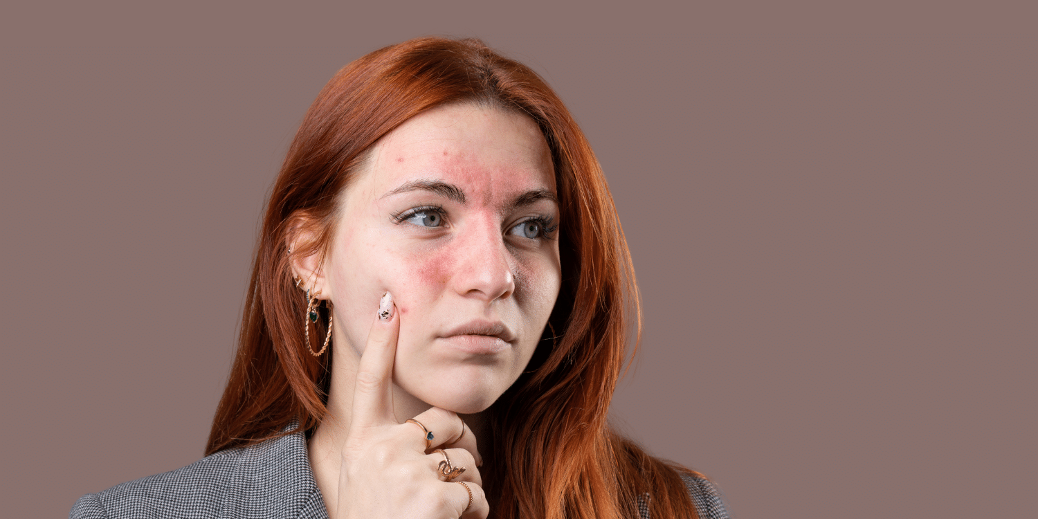 What Exactly is Acneiform Rosacea & How to Treat it?