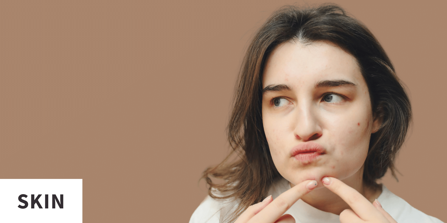 Purging vs Breakouts: Key Differences and Treatments