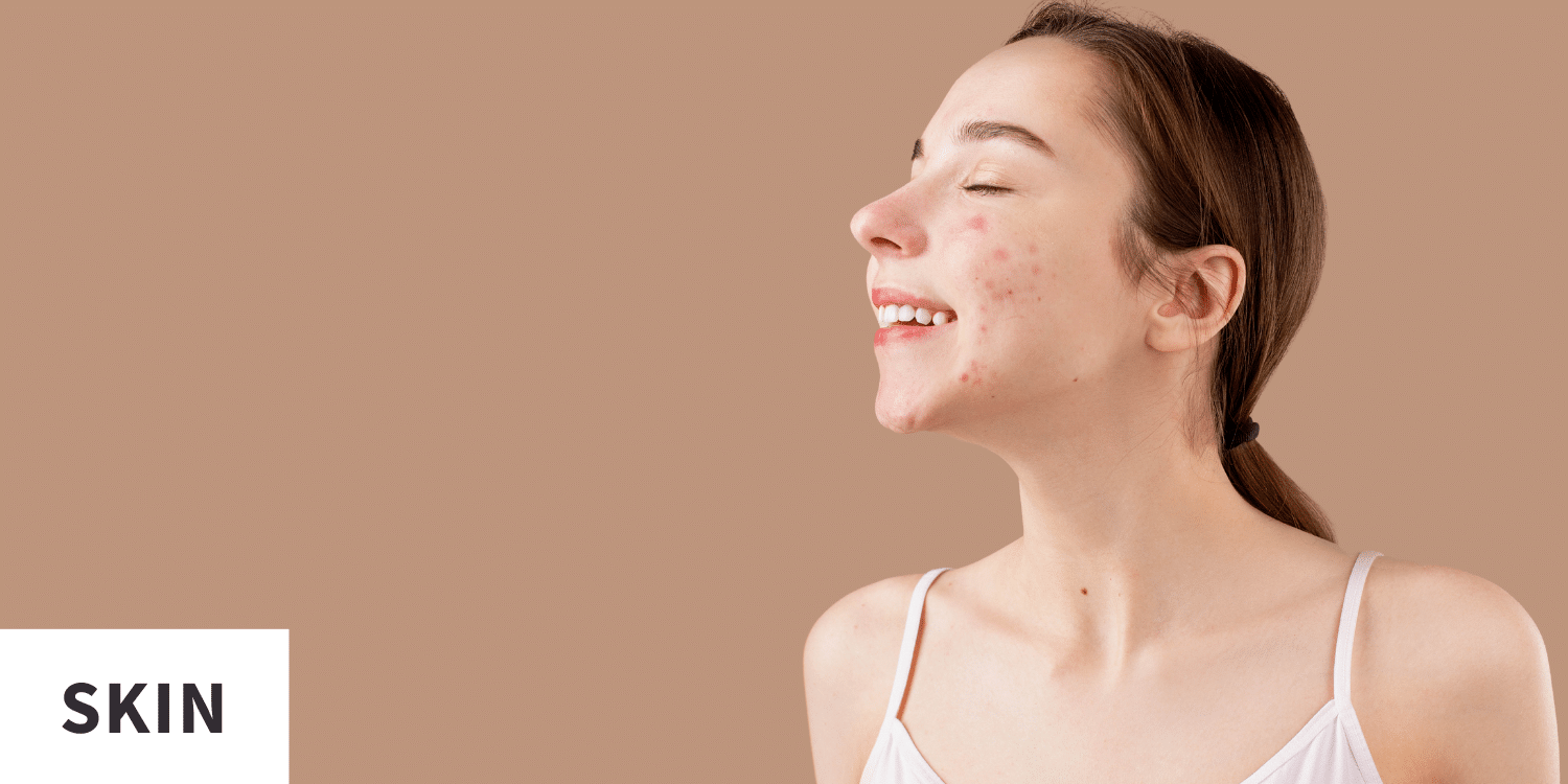 Post-Inflammatory Erythema vs Hyperpigmentation