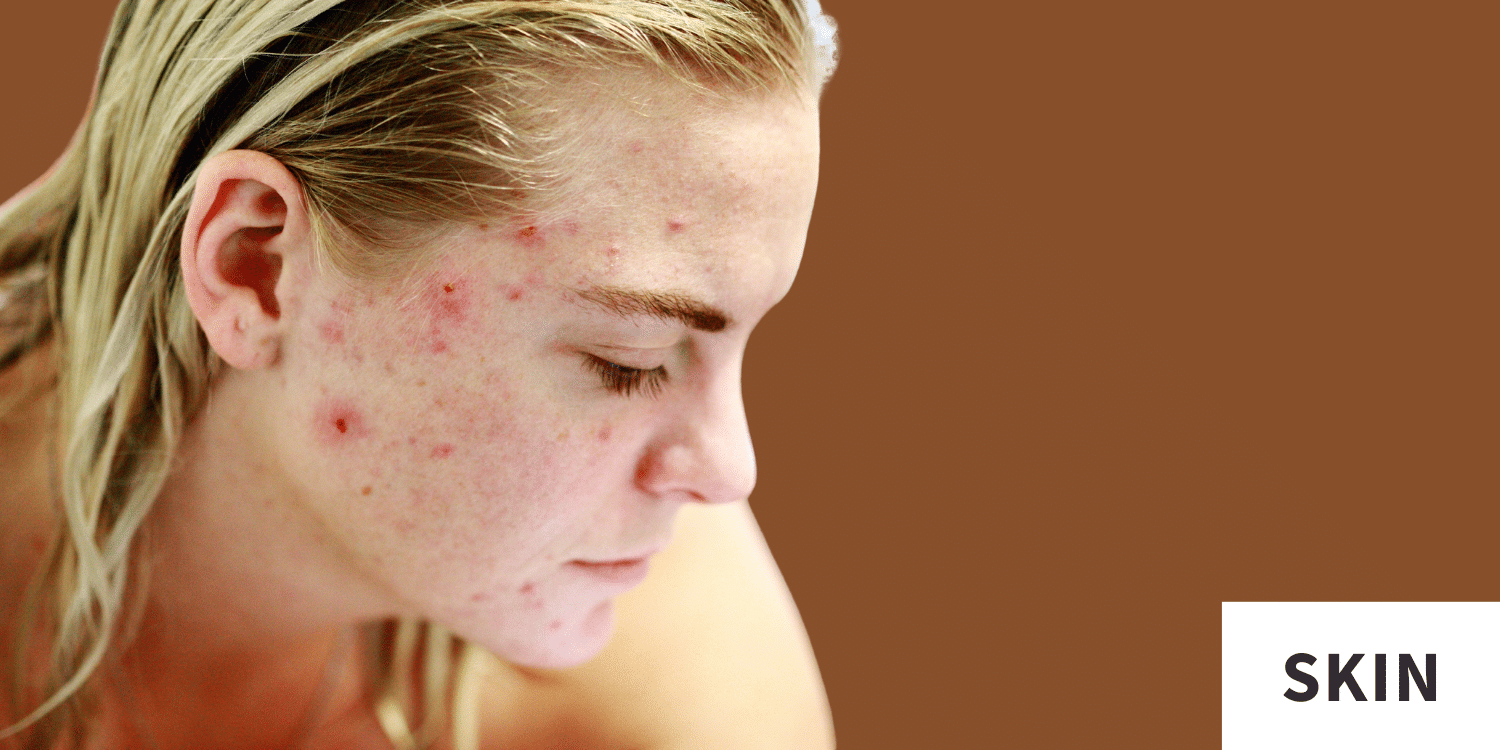 Closed Comedones vs Inflammatory Acne
