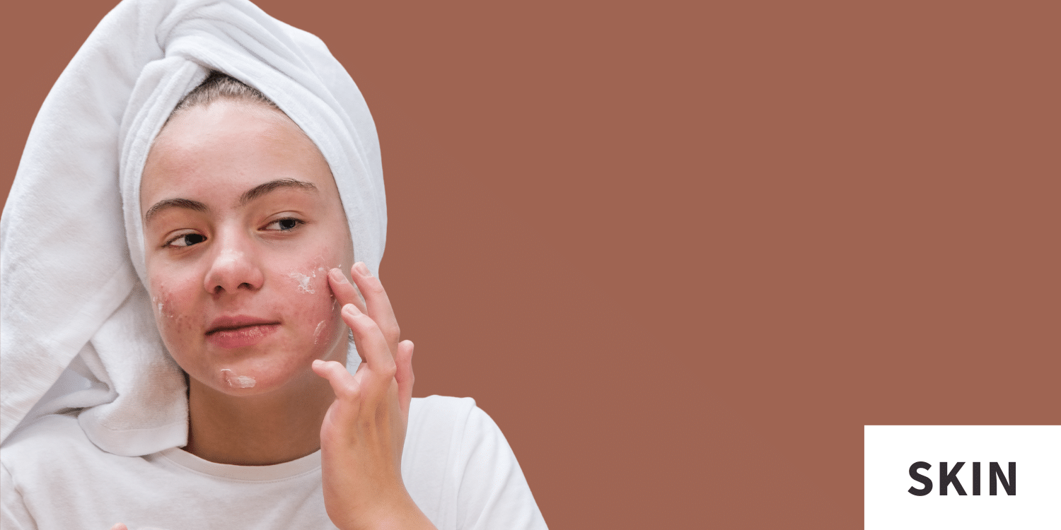 How Long Acne Treatment Takes to Work